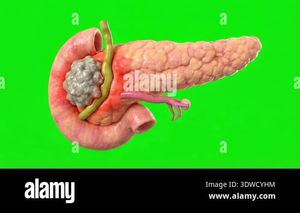 A detailed 3D rendering of the human pancreas with a visible tumor, set ...