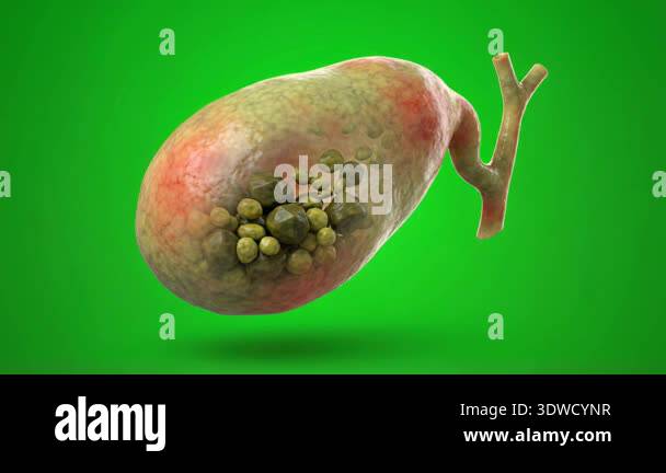 A detailed 3D medical animation showcasing a human gallbladder filled ...