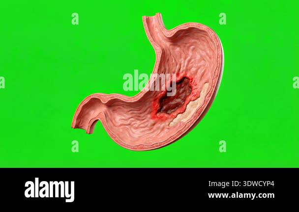 A detailed 3D animation of a stomach with a visible ulcer, set against ...