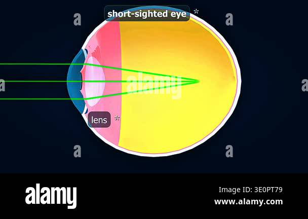 3d animation of short-sightedness or myopia showing blurred distant ...