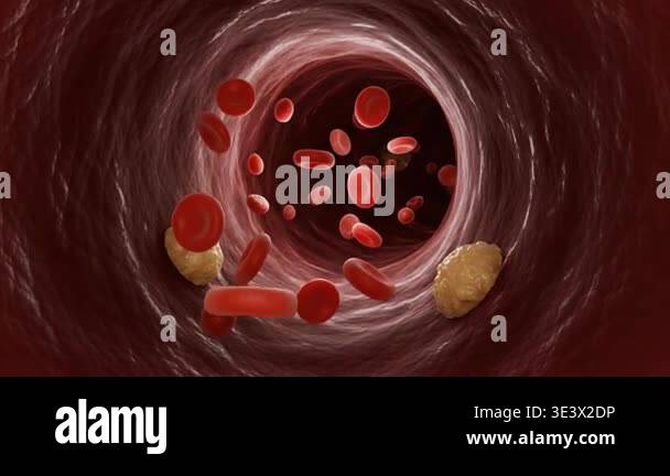 A detailed 3D animation showing red blood cells and cholesterol plaques ...