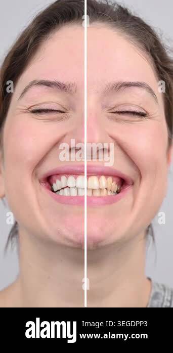 Caucasian woman smiling. Before and after teeth whitening. Collage ...