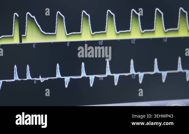 Close up of realtime monitoring waveform displayed on advanced ...