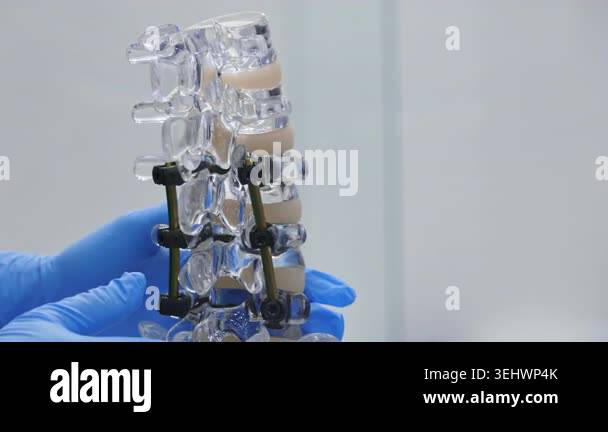 Specialist demonstrating advanced spinal stabilization implant with ...