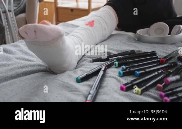 Young teenage girl with broken leg sitting on bed draws with felt tip ...