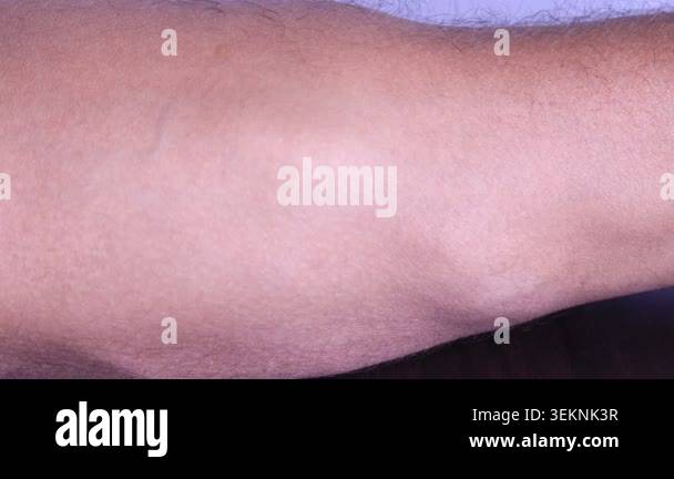 Man Pressing Multiple Lipoma Lumps on Forearm, Fatty Tumor Skin ...