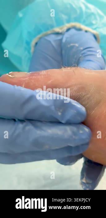 Medical worker in blue gloves inspects foot skin closely, highlighting ...
