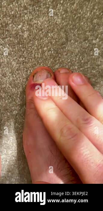 Individual treats inflamed toe with healing gel, demonstrating the ...