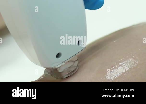 Beauty master makes laser hair removal epilation of legs skin close-up ...