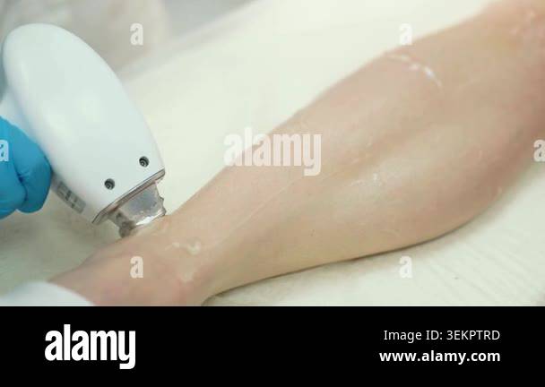 Beauty master makes laser hair removal epilation of legs skin close-up ...