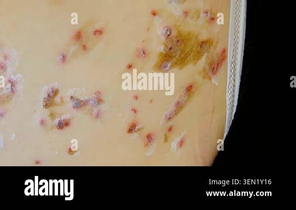 Step by step dermatology procedure showing professional removal of ...