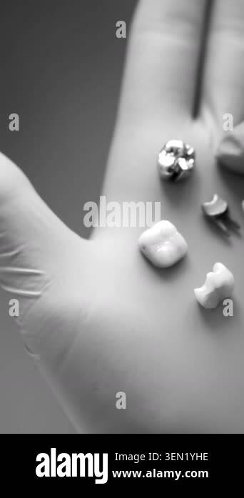 Black white video of dentist holding dental crowns implants and ...