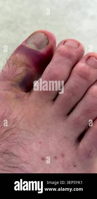Swollen toe with hematoma depicted across three frames, illustrating ...