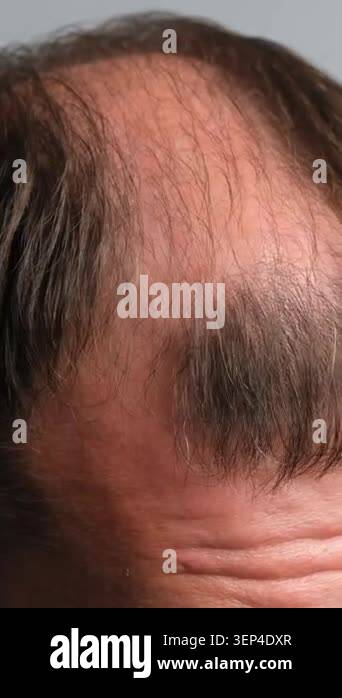 Close-up of a man s head with visible bald spot and thinning hair ...