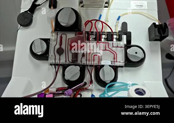 Overhead close-up of an apheresis machine manifold separating blood ...