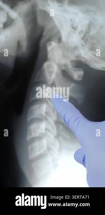 Doctor radiologically analyzing the neck spinal column with x-ray.Glove ...