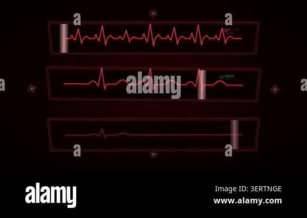 Medical Heart Rate Monitor Screen Displaying Cardiac Flatline Stock ...