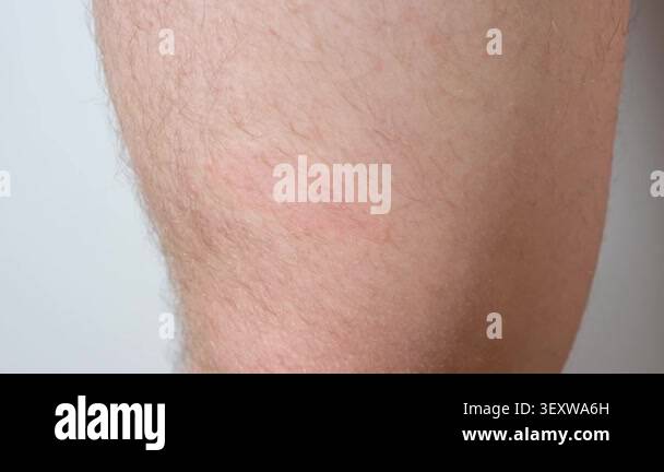 Erythema migrans rash caused by Lyme disease. Borreliosis symptom Stock ...