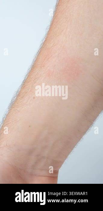 Erythema migrans rash caused by Lyme disease. Borreliosis symptom Stock ...