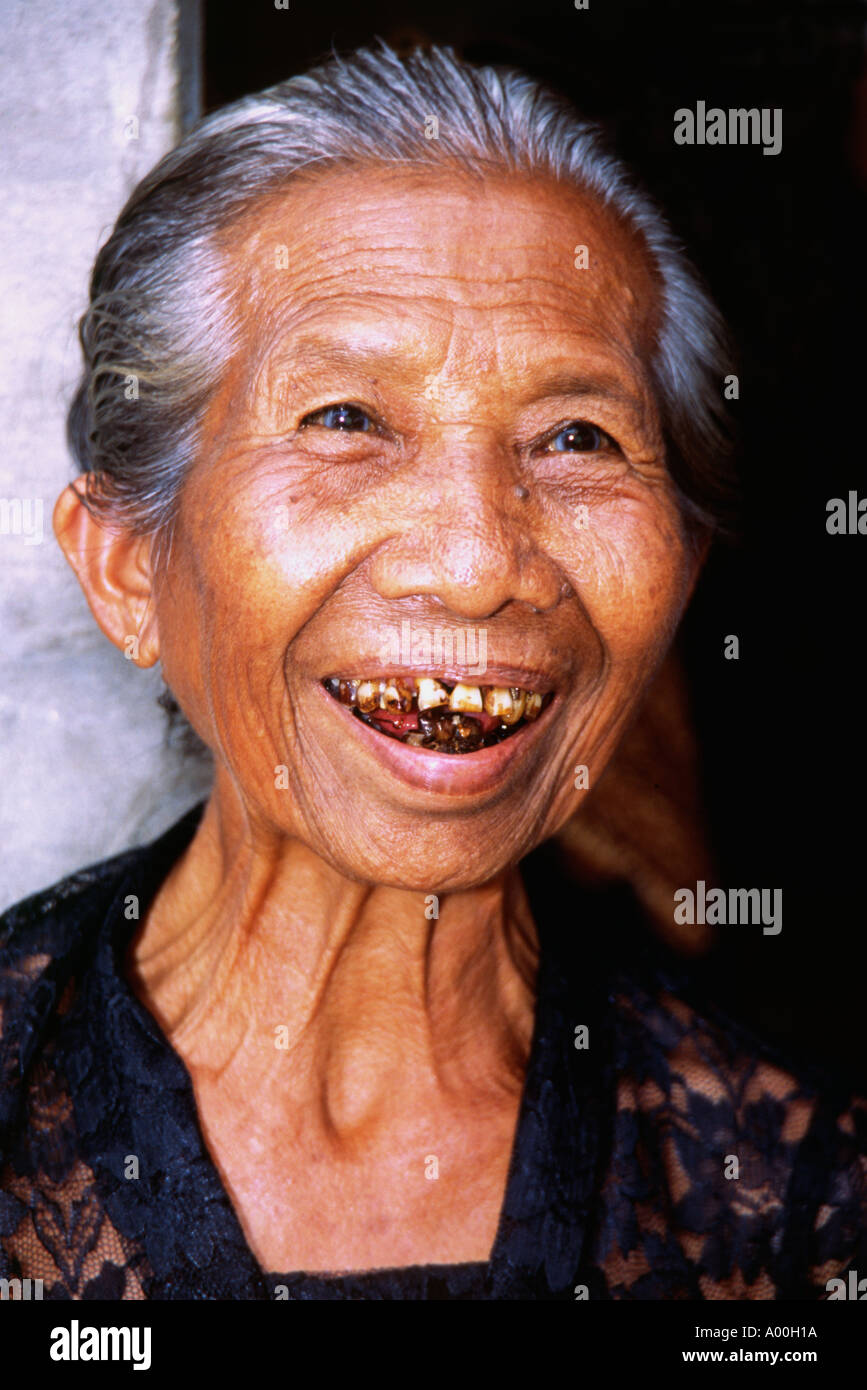 Rotten teeth woman hi-res stock photography and images - Alamy