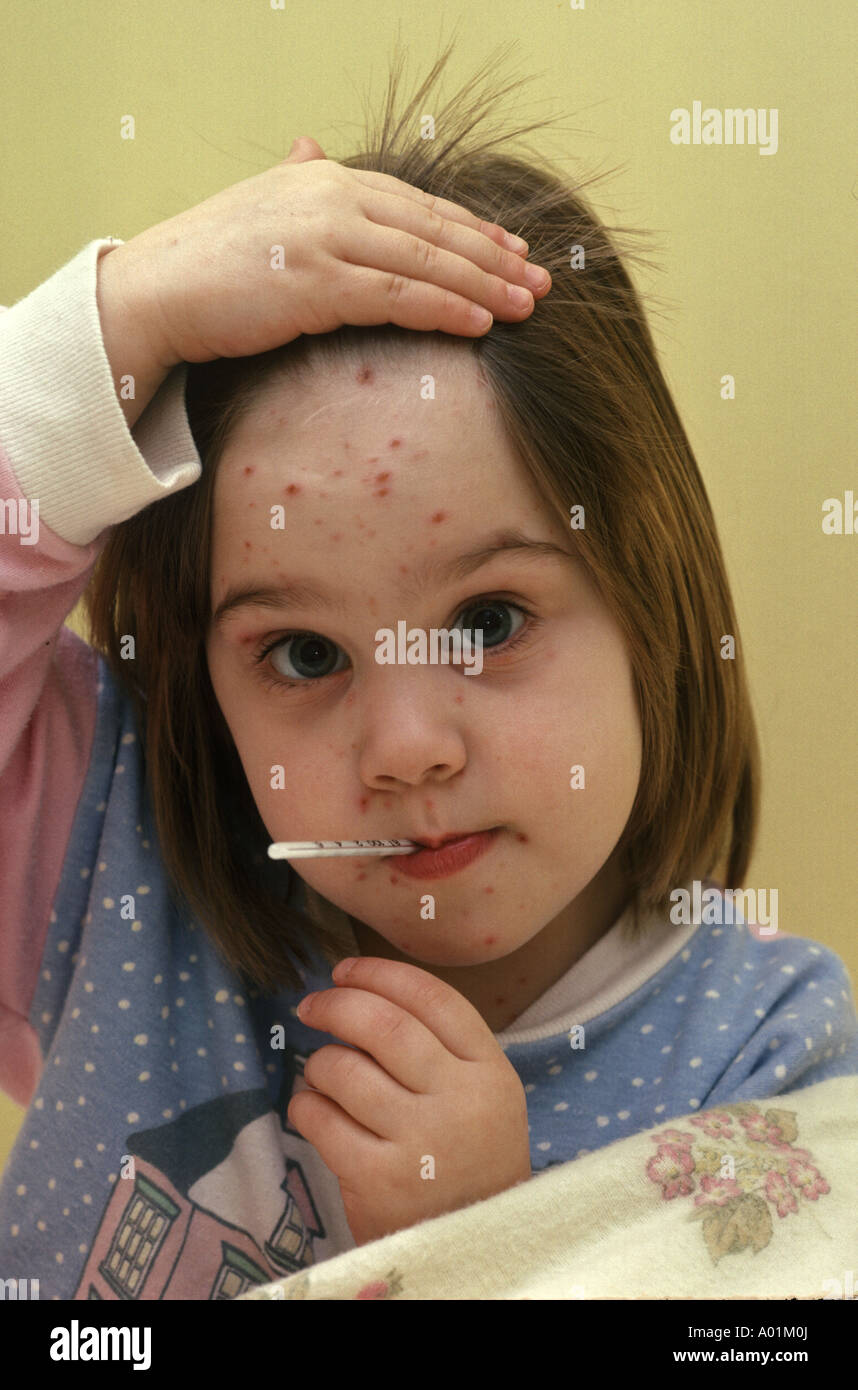 toddler with chicken pox showing many spots on her face and head Stock ...