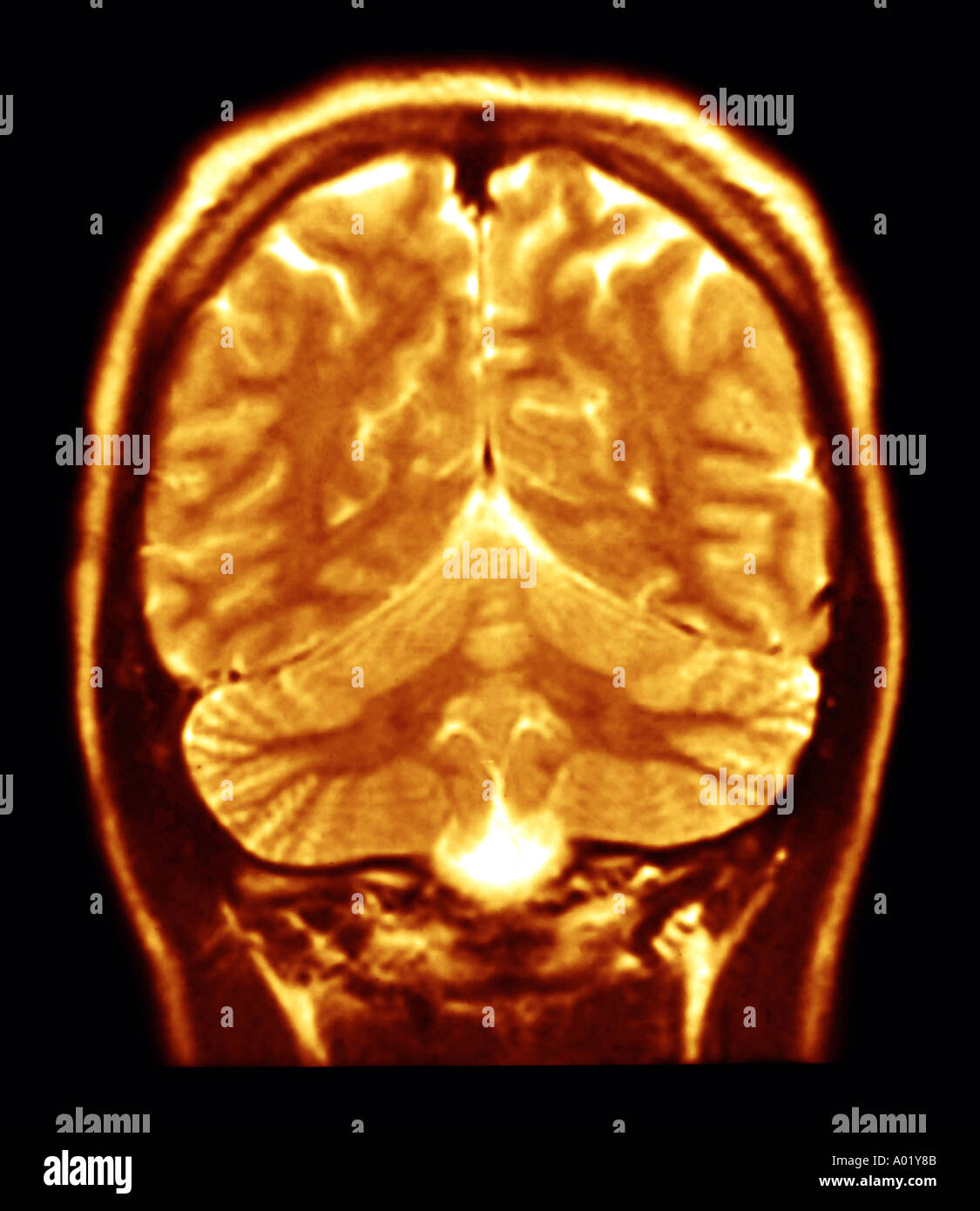 prominent cerebral sulci greater than expected for patient s young age ...