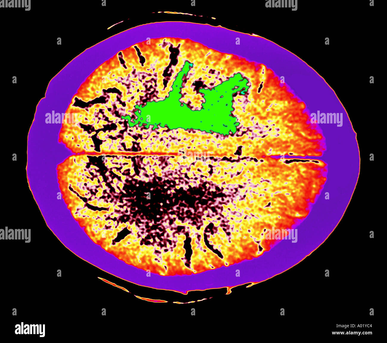 CAT scan showing brain edema from a tumor Stock Photo - Alamy