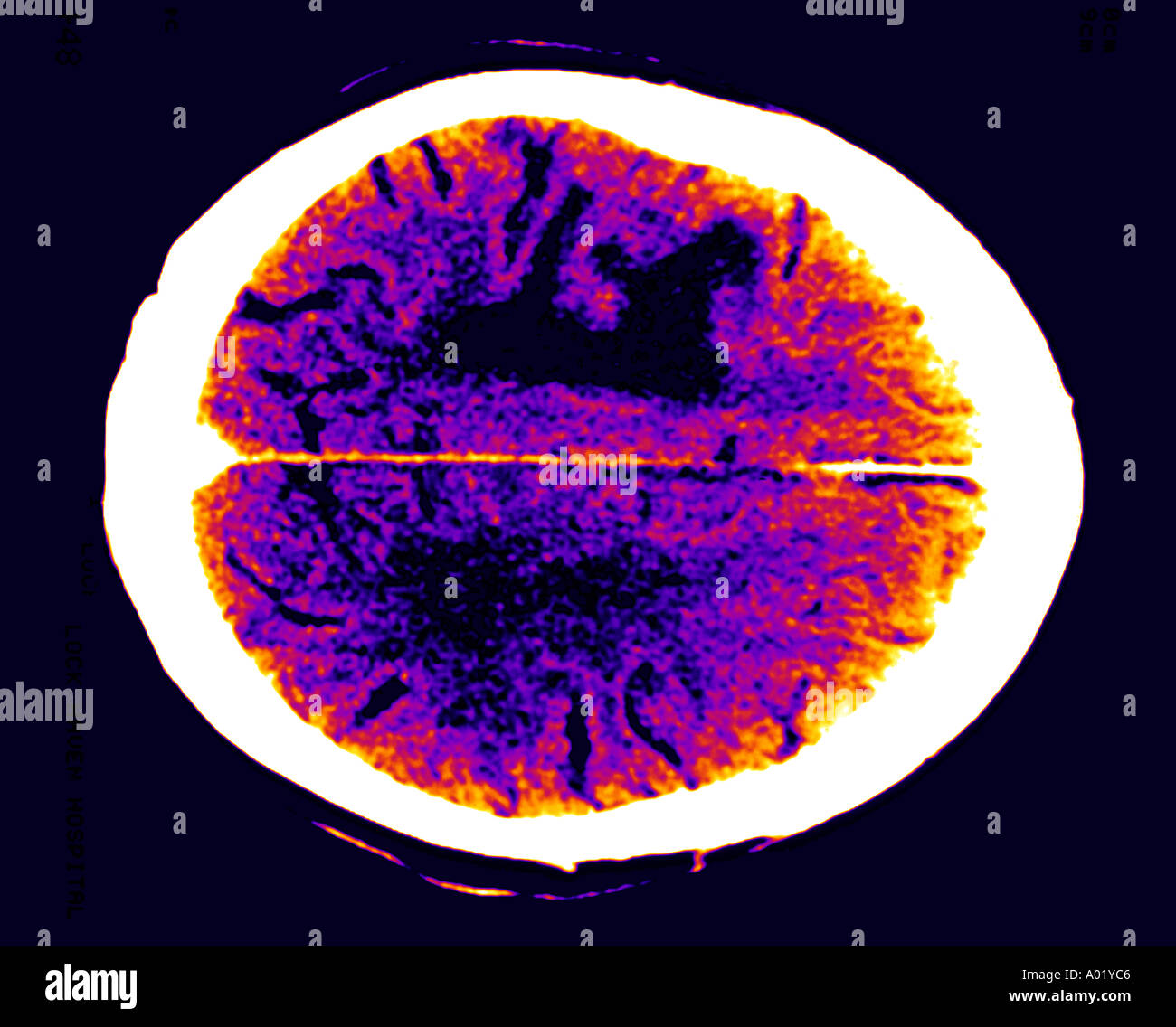 CAT scan showing brain edema from a tumor Stock Photo - Alamy