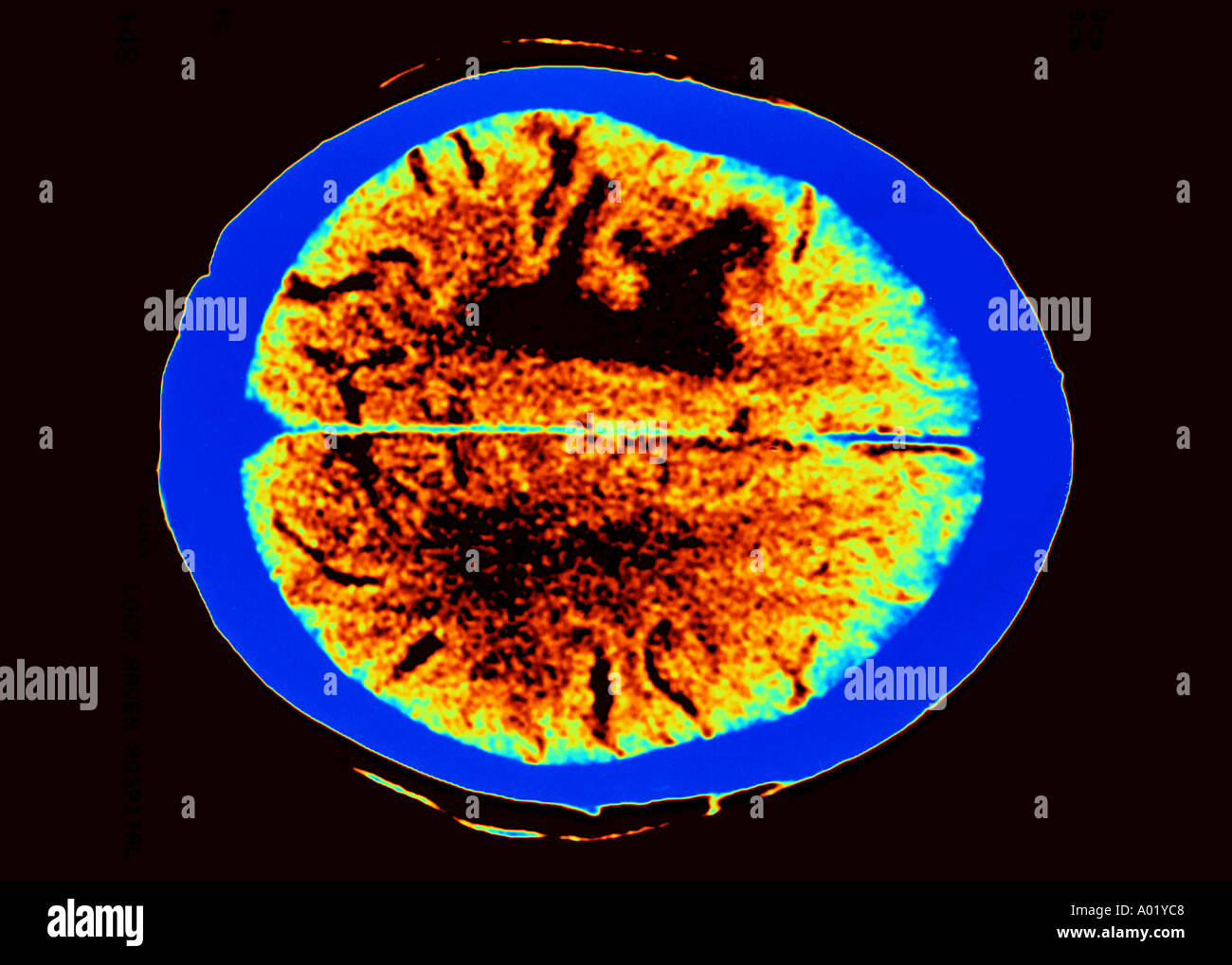 CAT scan showing brain edema from a tumor Stock Photo - Alamy