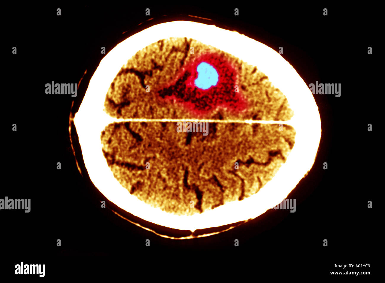 CAT scan showing brain edema from a tumor Stock Photo - Alamy