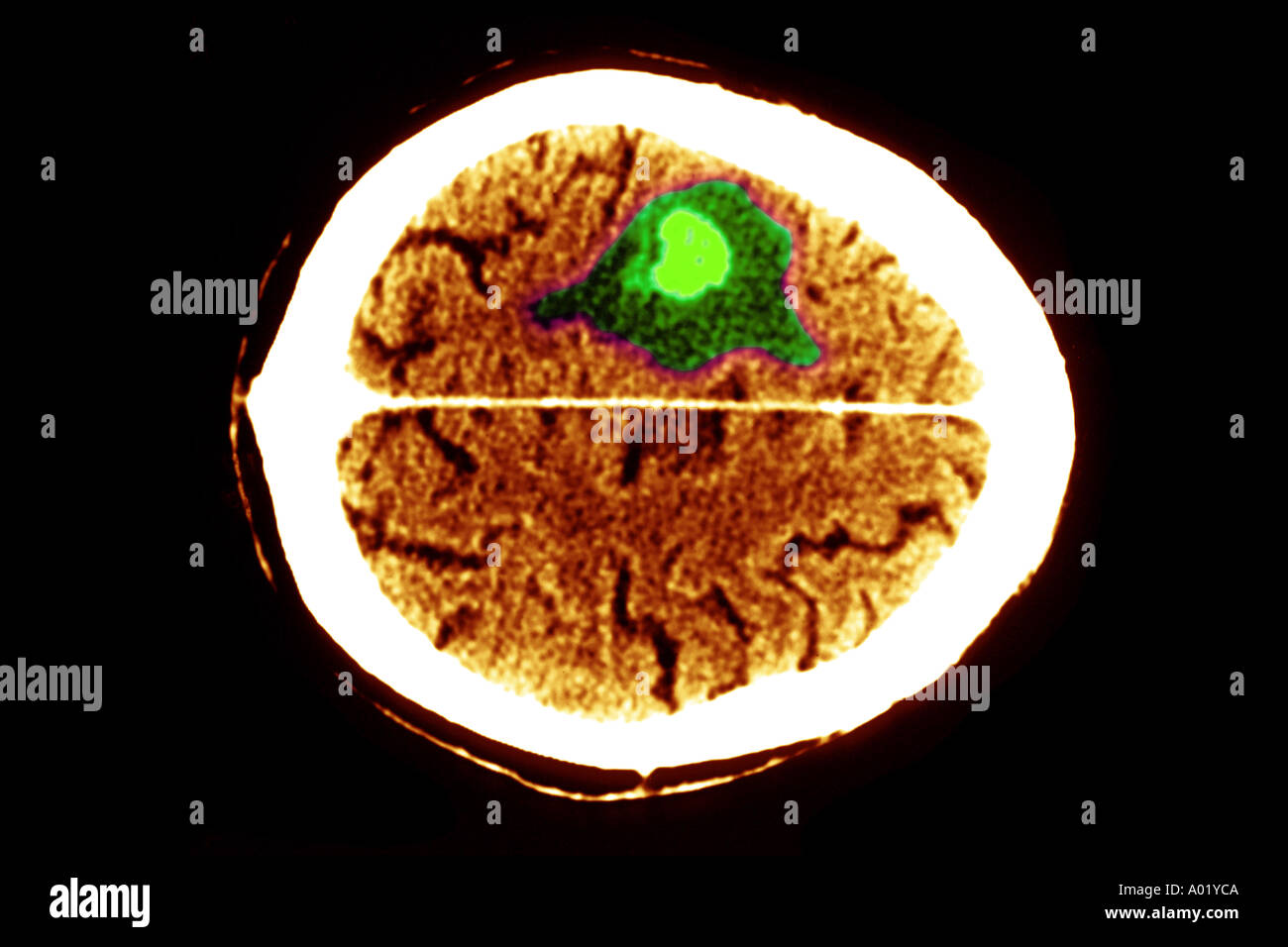 CAT scan showing brain tumor and edema Stock Photo - Alamy
