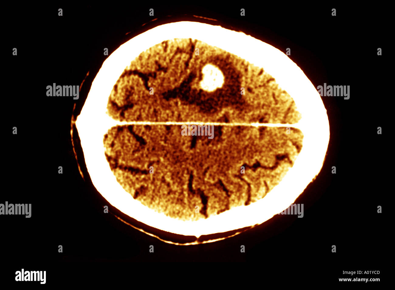 Brain edema ct scan hi-res stock photography and images - Alamy