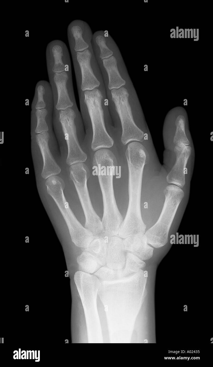 x ray of hand Stock Photo - Alamy