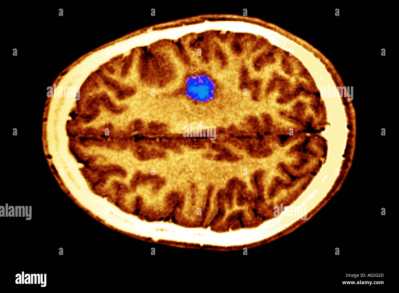 CAT scan showing glioma brain tumor Stock Photo - Alamy