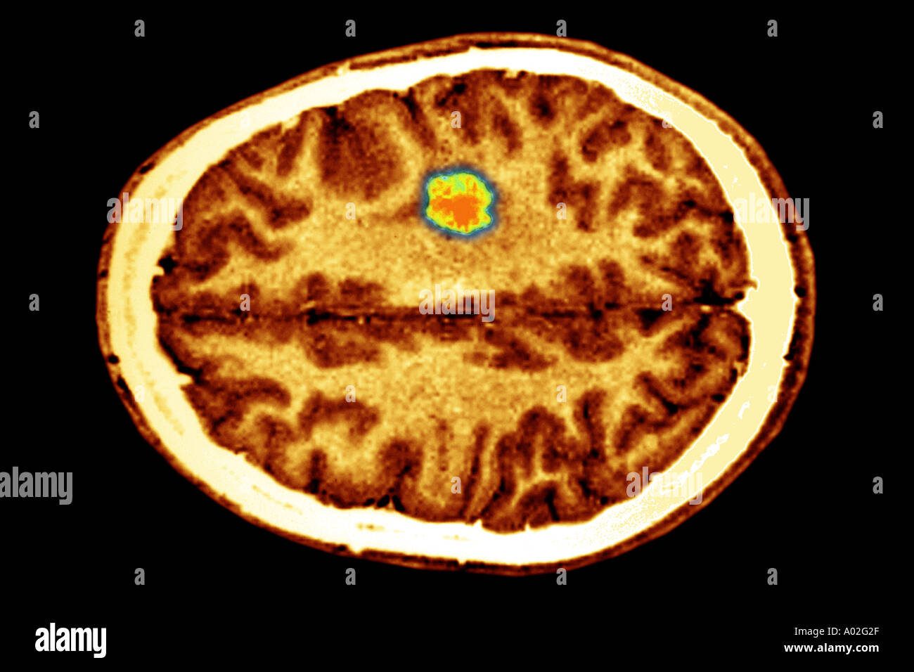 CAT scan showing glioma brain tumor Stock Photo - Alamy