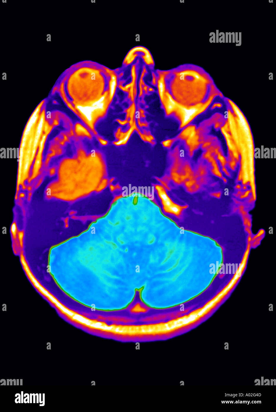 Mri scan eyes hi-res stock photography and images - Alamy