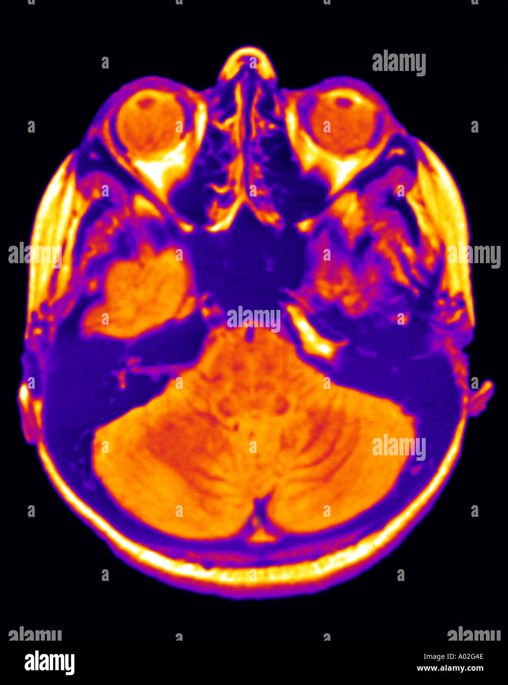 MRI brain scan of a woman Stock Photo - Alamy