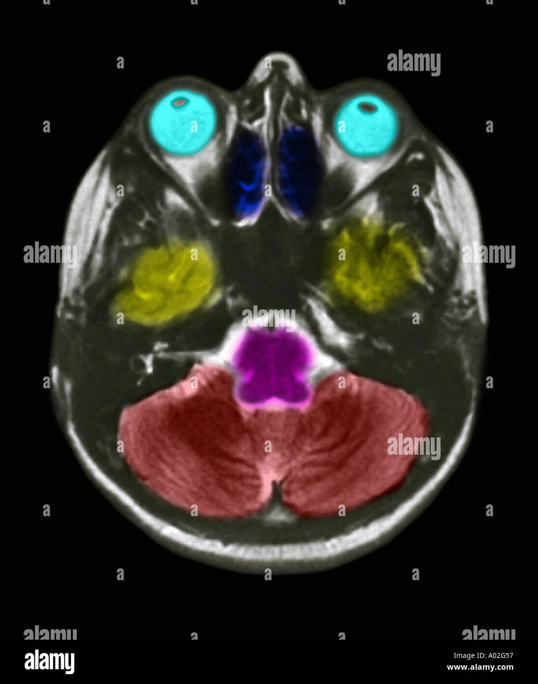 MRI brain scan of a woman Stock Photo - Alamy