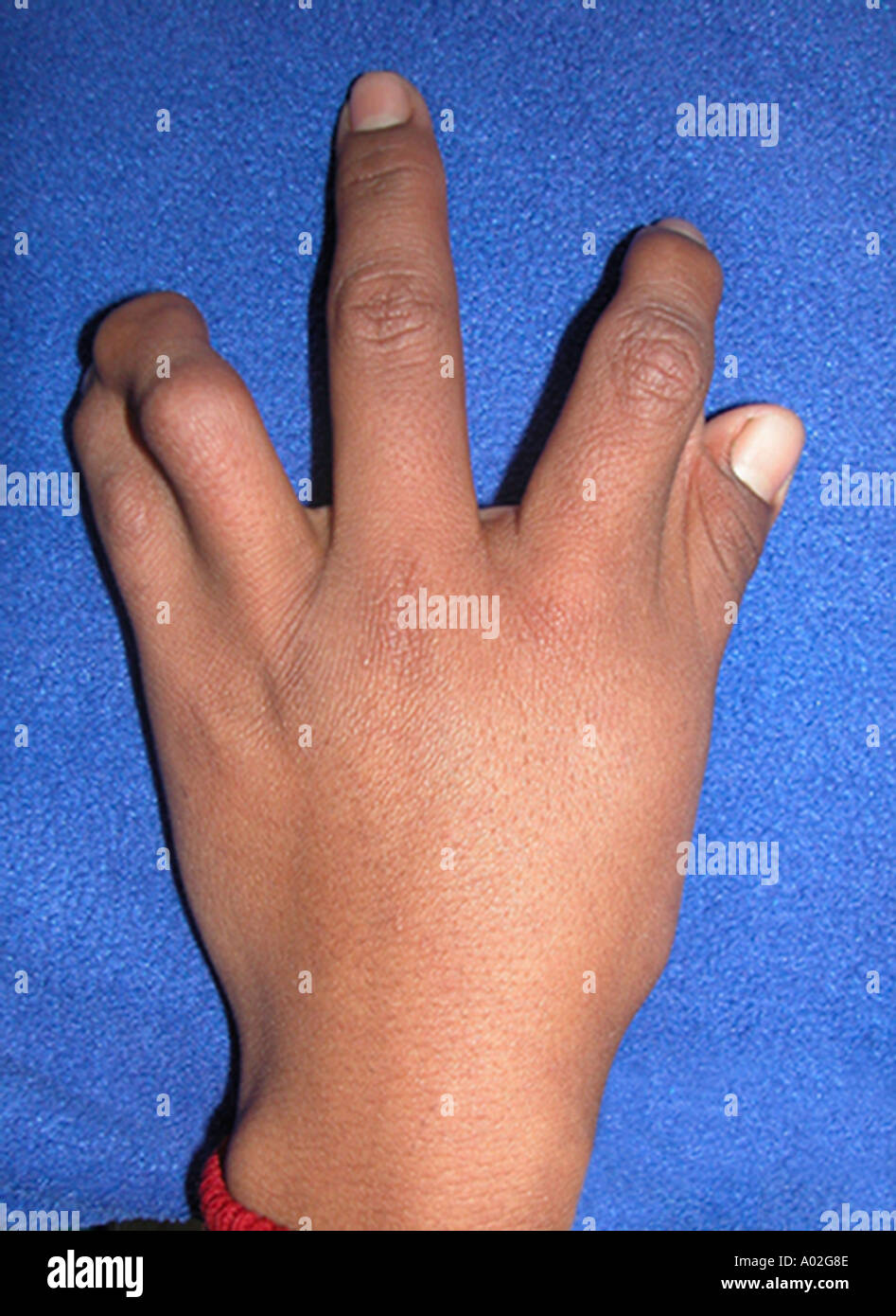 Developmental abnormality hi-res stock photography and images - Alamy