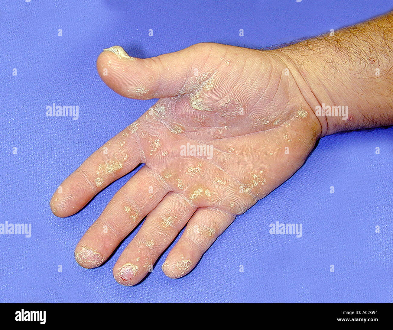 38 year old male with history of psoriasis since he was a teenager ...