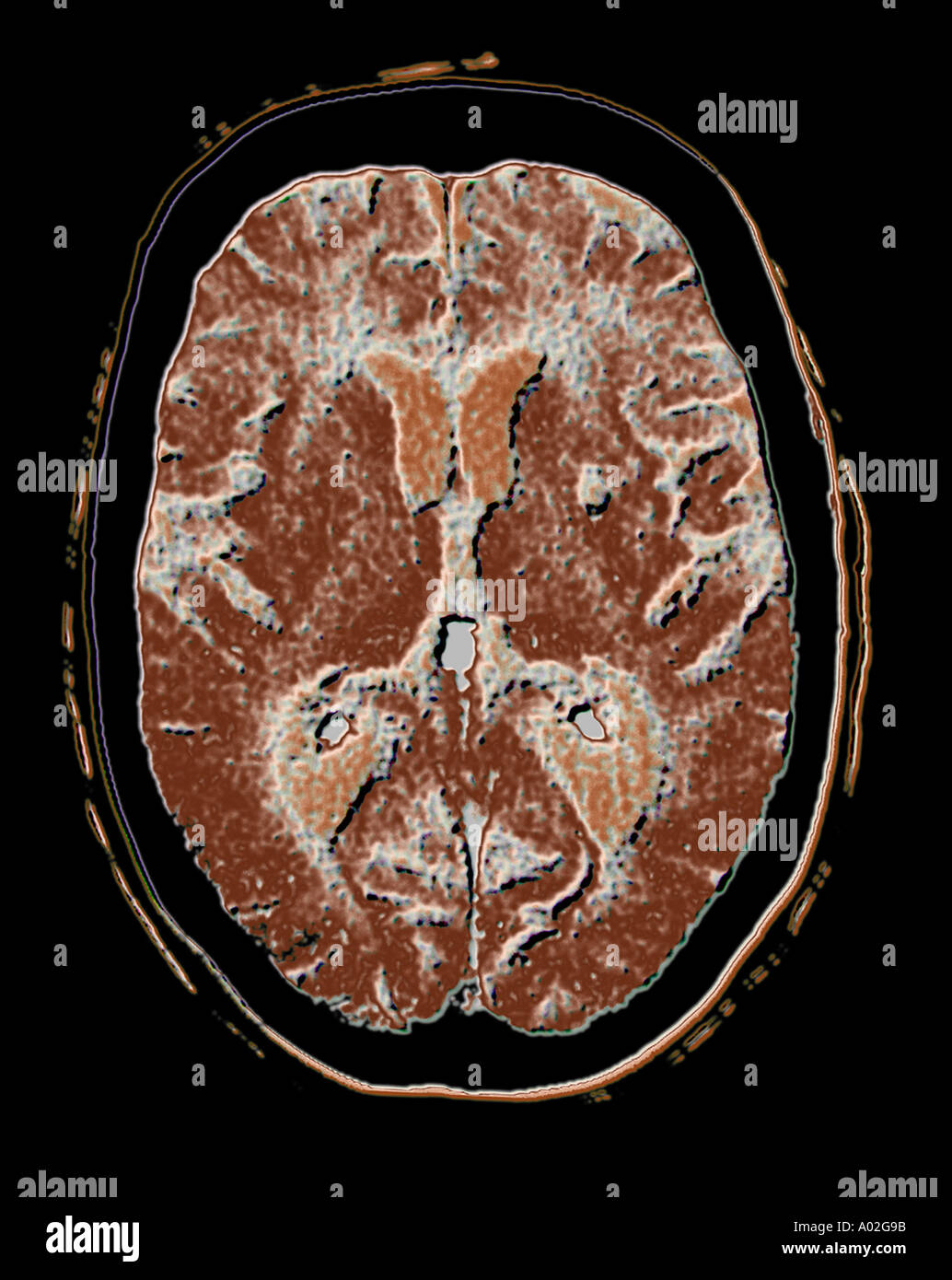 brain scan showing cerebral atrophy Stock Photo - Alamy