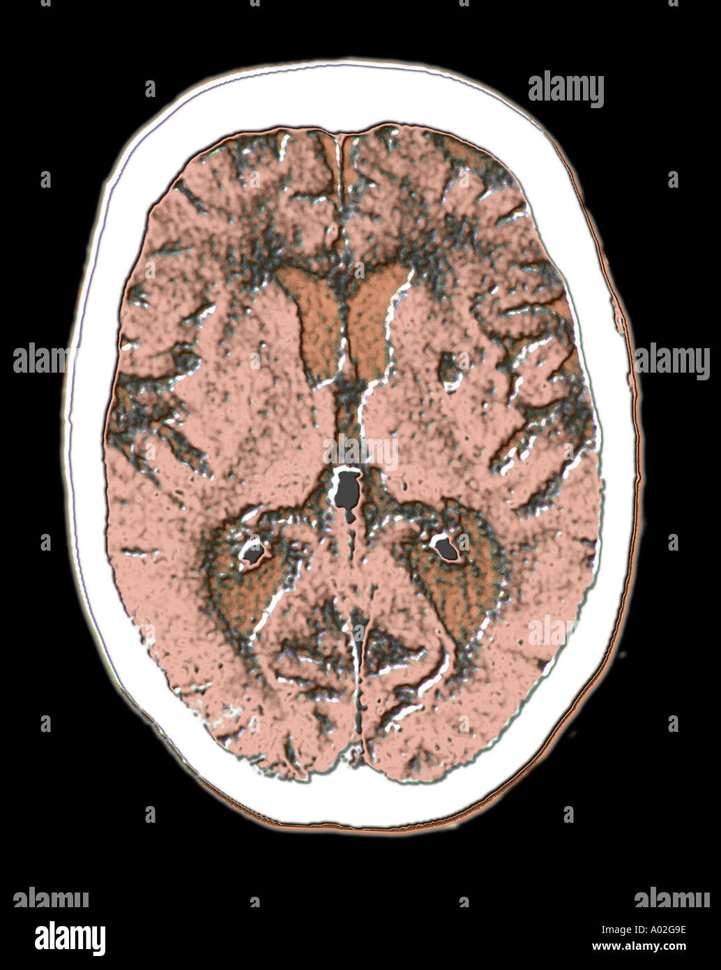 brain scan showing cerebral atrophy Stock Photo - Alamy brain scan showing cerebral atrophy Stock Photo - Alamy