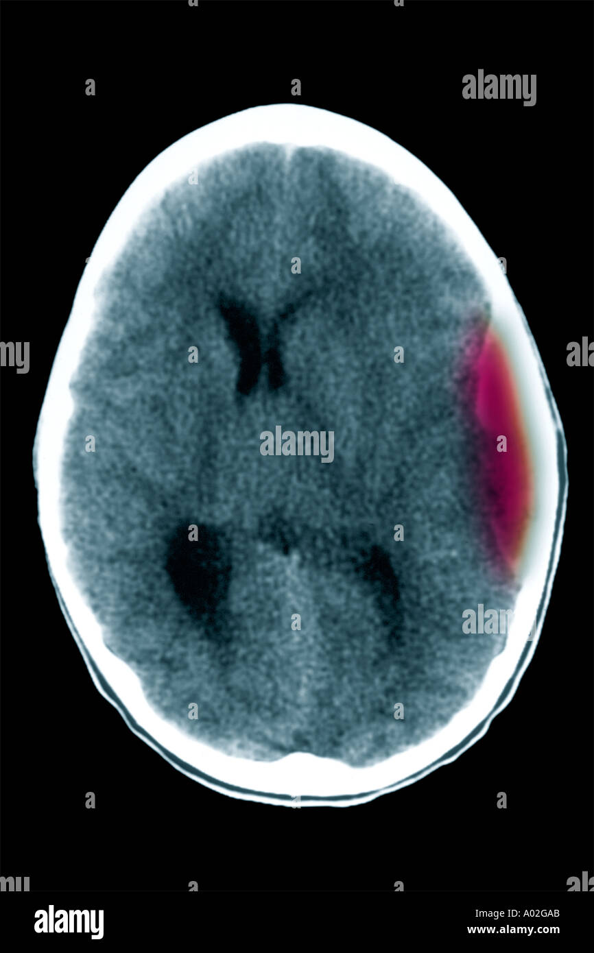 CT scan brain 10 year old boy epidural hematoma from trauma. The ...