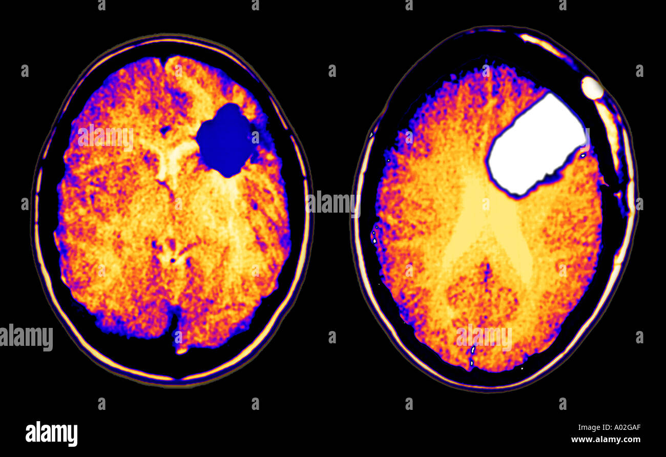 CT scan showing brain glioma in a 16 year old girl before surgery and ...