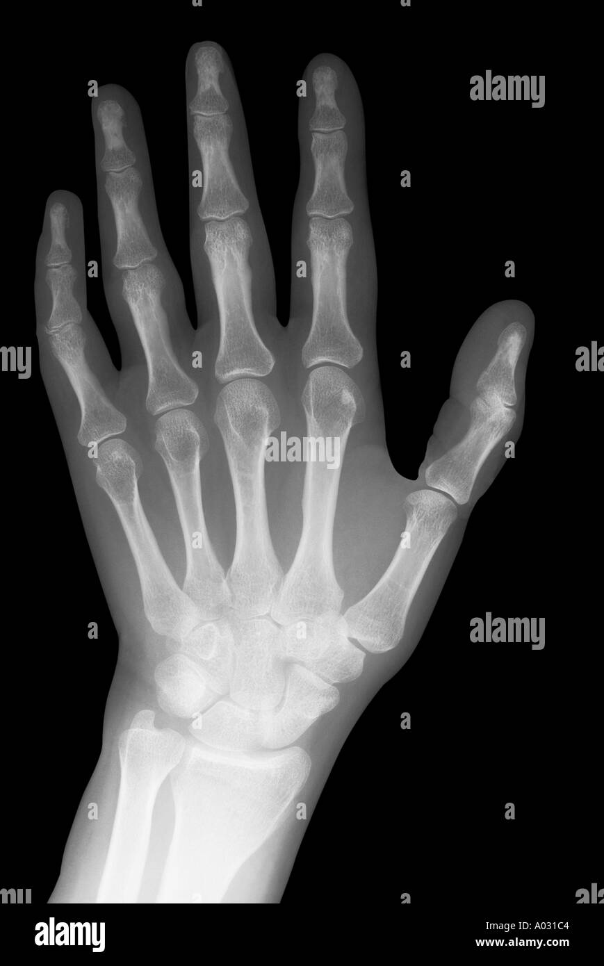 x ray of hand Stock Photo - Alamy