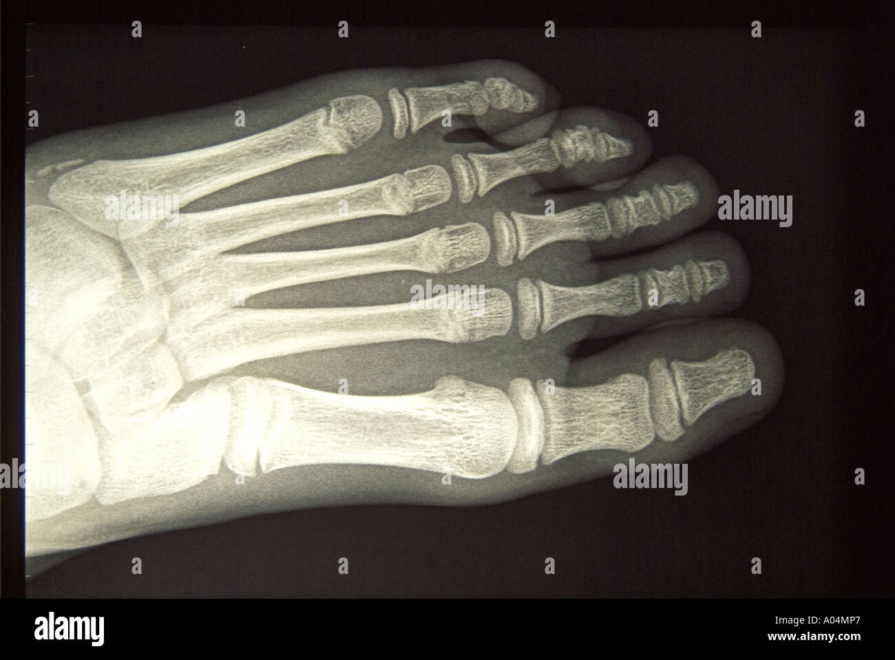 Normal Left Foot Xray