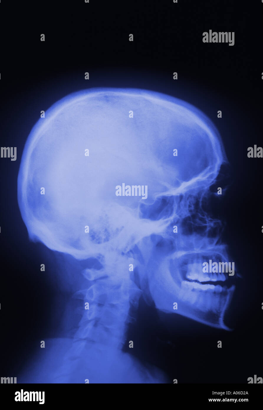 skull x ray Stock Photo - Alamy