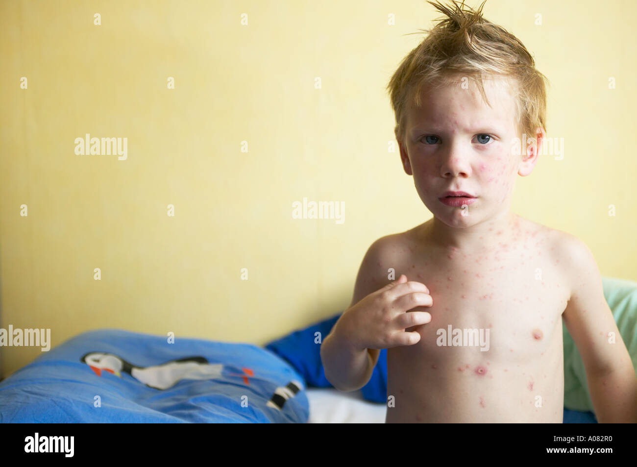 Young boy sick with chicken pox on his bed DEU GERMANY Stock Photo - Alamy