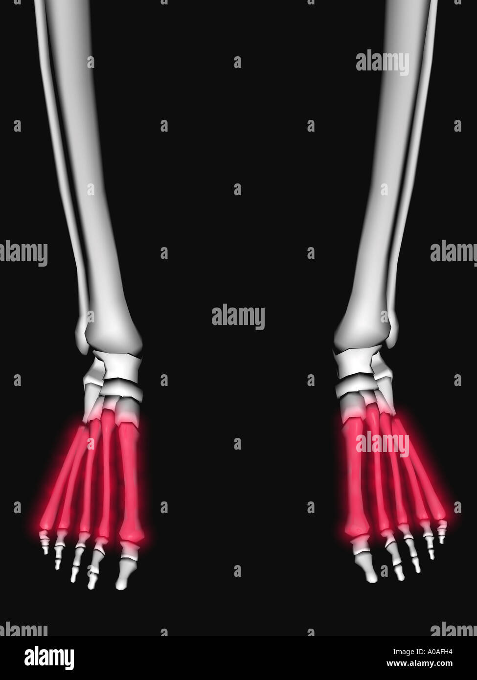 Metatarsal Fracture High Resolution Stock Photography and Images - Alamy
