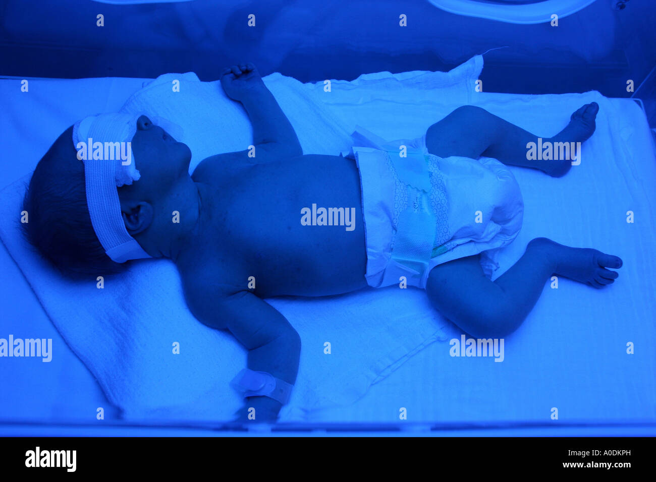 Premature baby with jaundice having phototherapy Stock Photo - Alamy